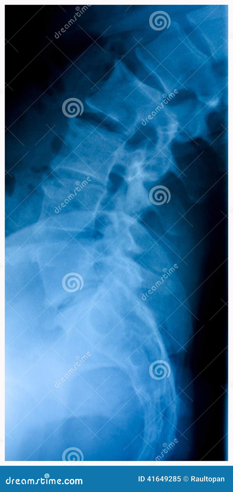 Lumbar Spine X-ray Royalty-Free Stock Photo | CartoonDealer.com #41649285