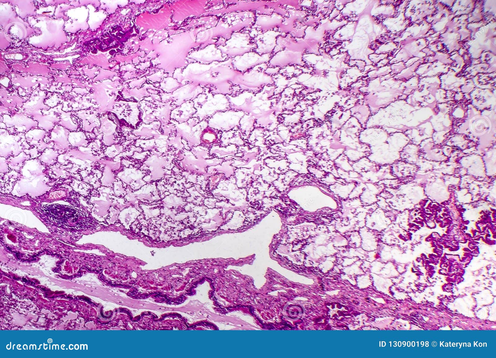 Lung Adenocarcinoma, Light Micrograph Royalty-Free Stock Image ...
