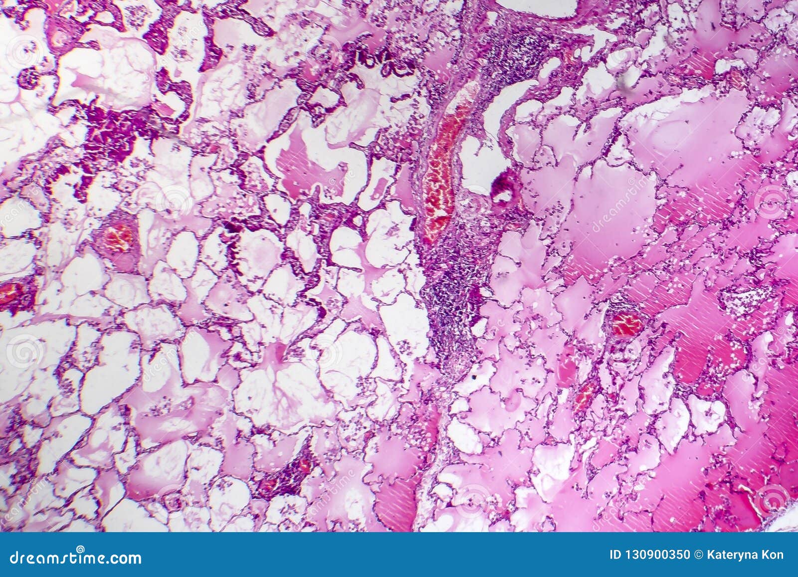 Lung adenocarcinoma stock photo. Image of cell, tissue - 130900350