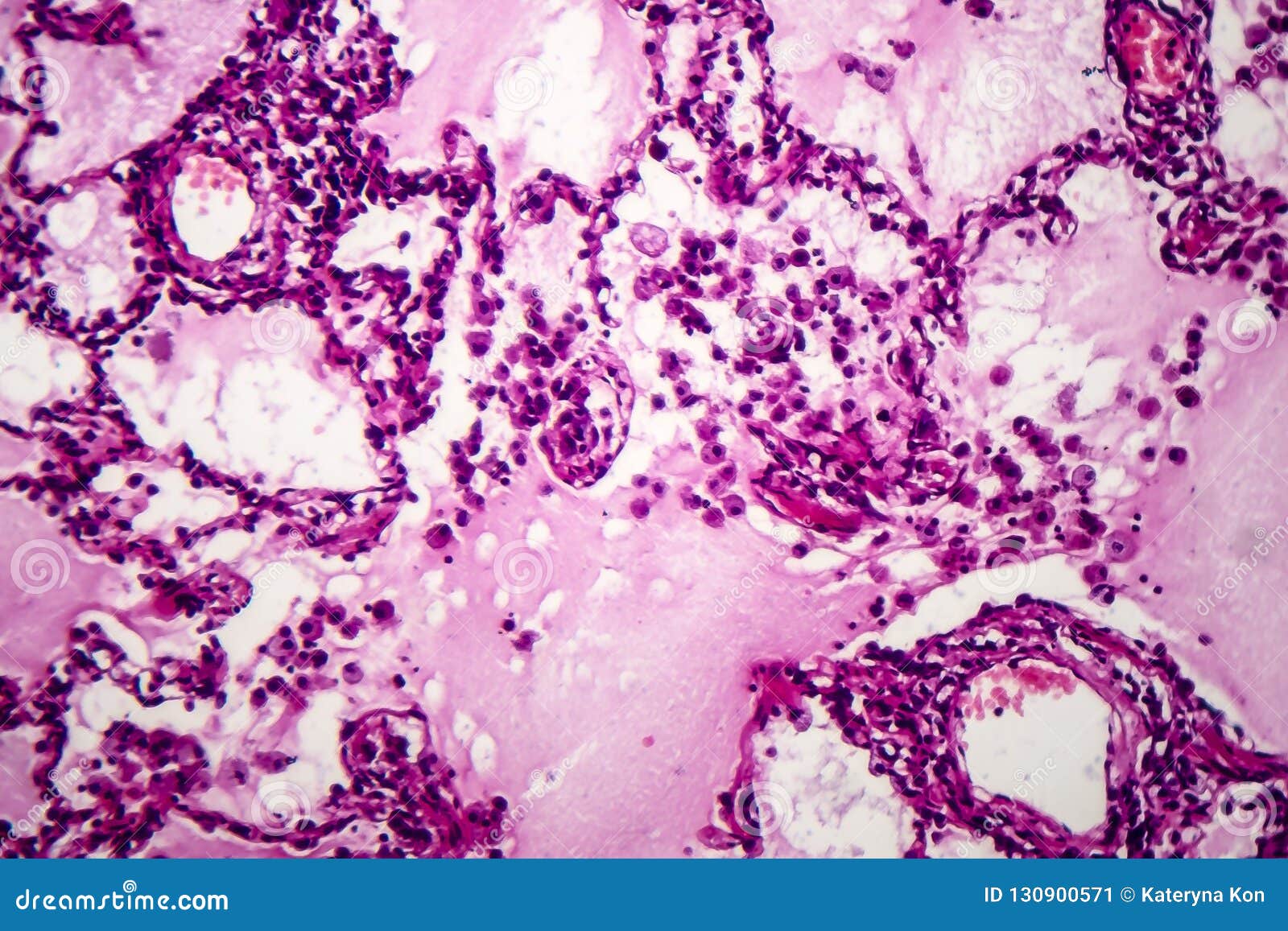 Lung Adenocarcinoma, Light Micrograph Royalty-Free Stock Image ...