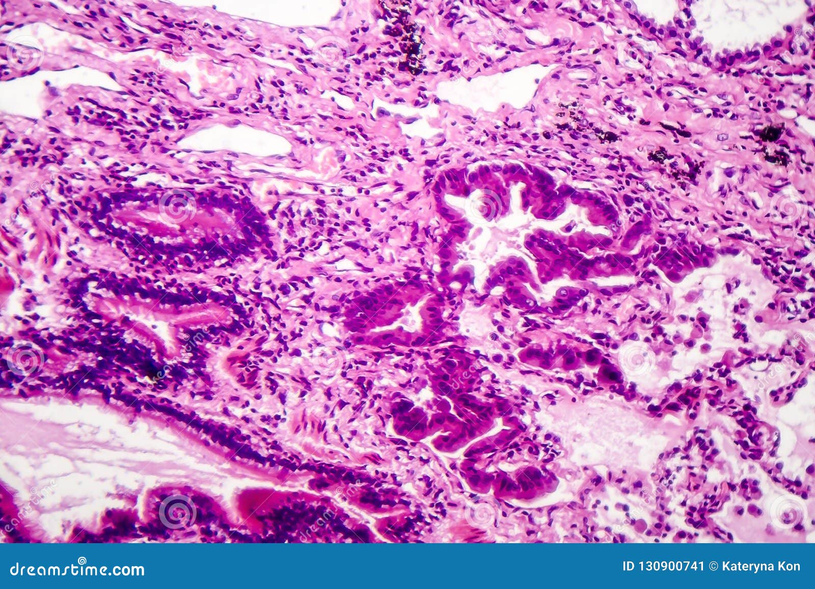 Lung Adenocarcinoma, Light Micrograph Stock Photography | CartoonDealer ...