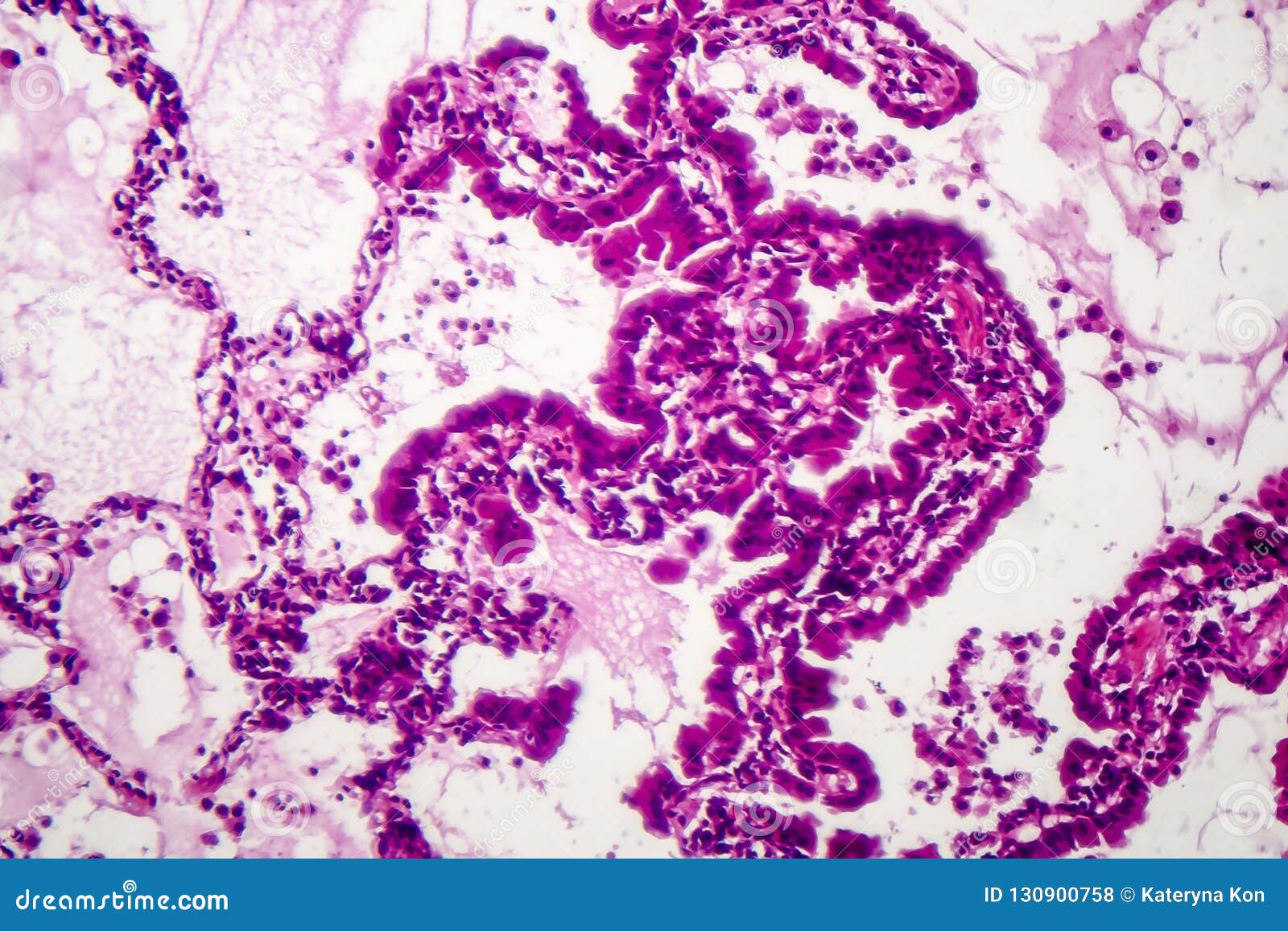 Lung adenocarcinoma stock photo. Image of pathology - 130900758