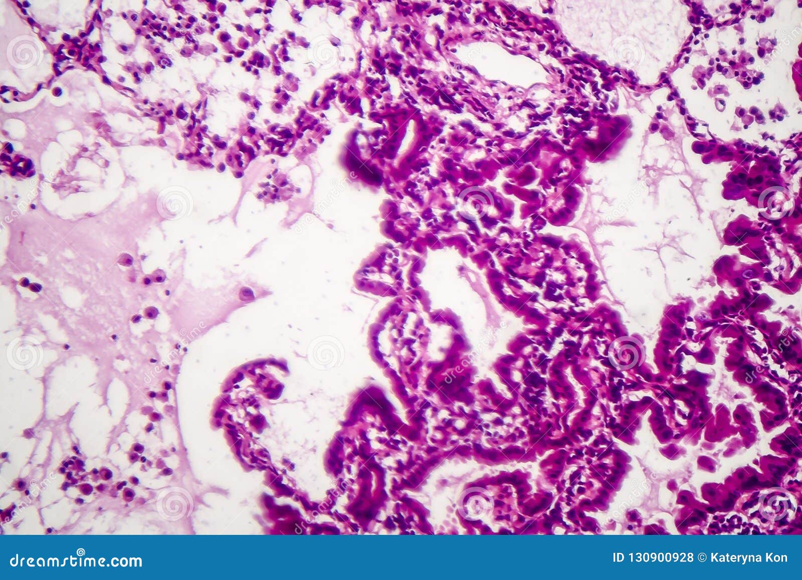 Lung adenocarcinoma stock photo. Image of hematoxylin - 130900928