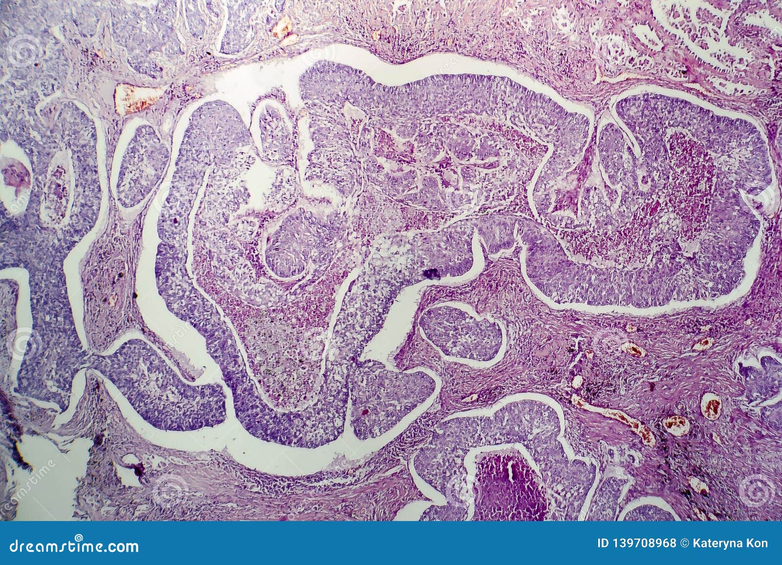 Lung Adenocarcinoma, Light Micrograph Stock Photo - Image of ...
