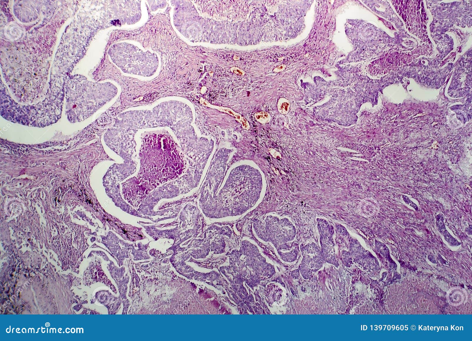 Lung Adenocarcinoma, Light Micrograph Stock Image - Image of tissue ...