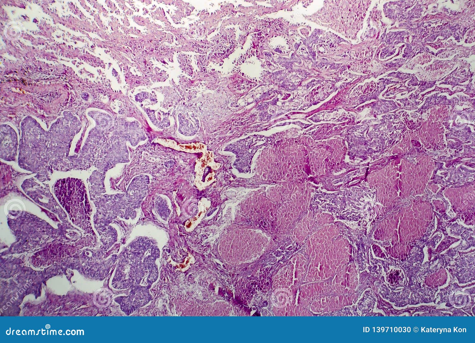 Lung Adenocarcinoma, Light Micrograph Stock Photo - Image of ...