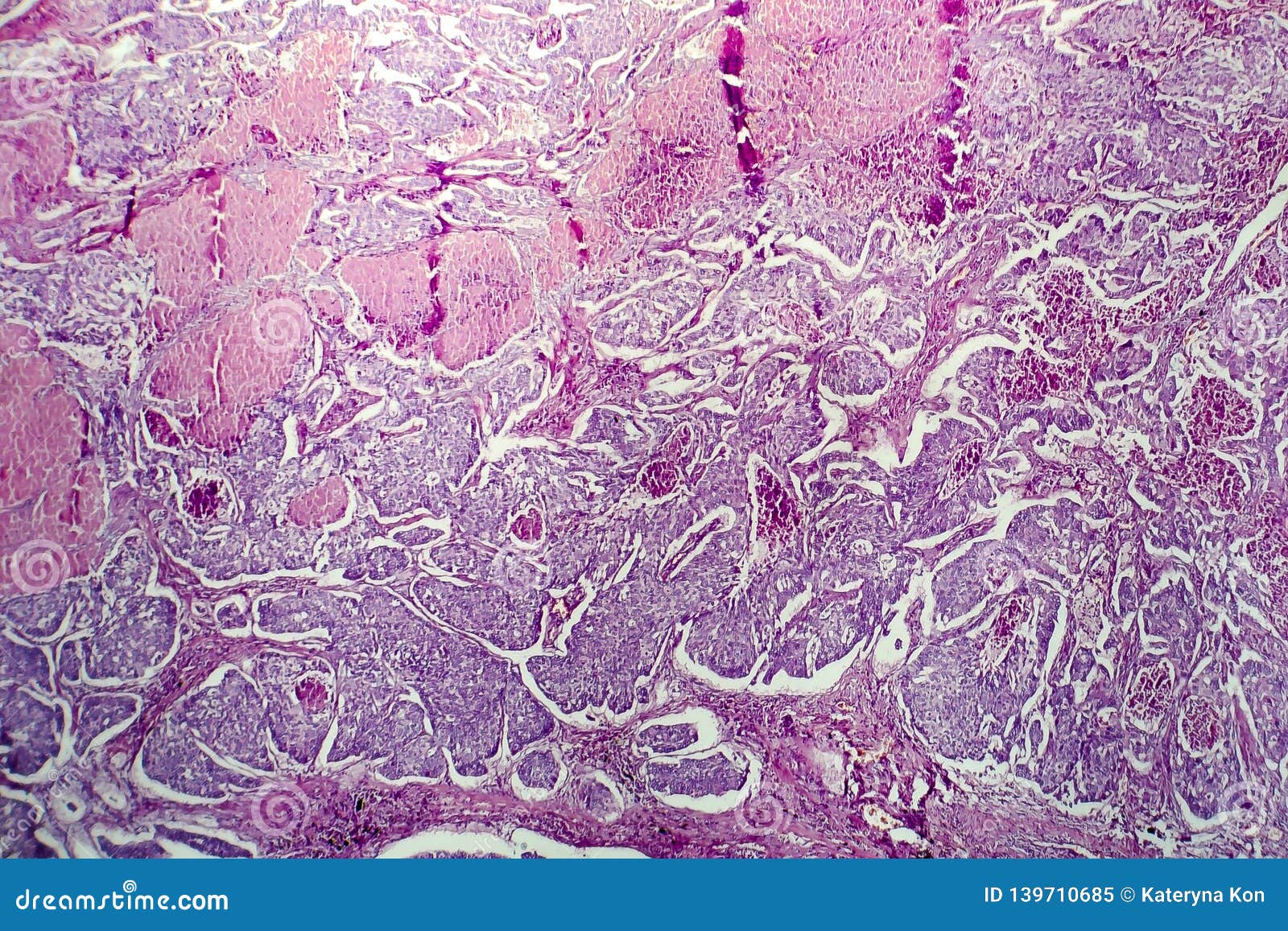 Lung Adenocarcinoma, Light Micrograph Stock Image - Image of pulmonary ...