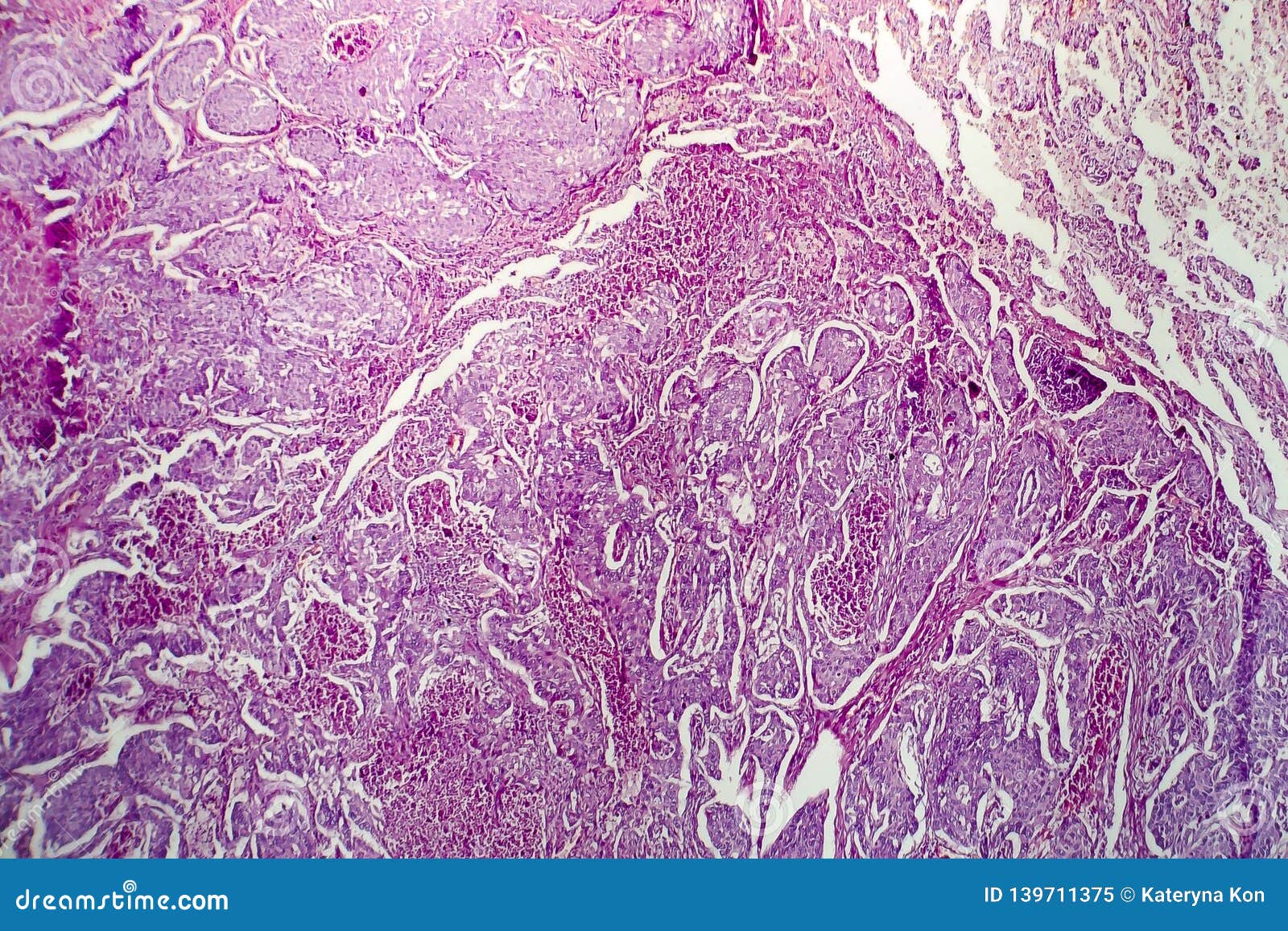 Lung Adenocarcinoma, Light Micrograph Stock Image - Image of pathology ...