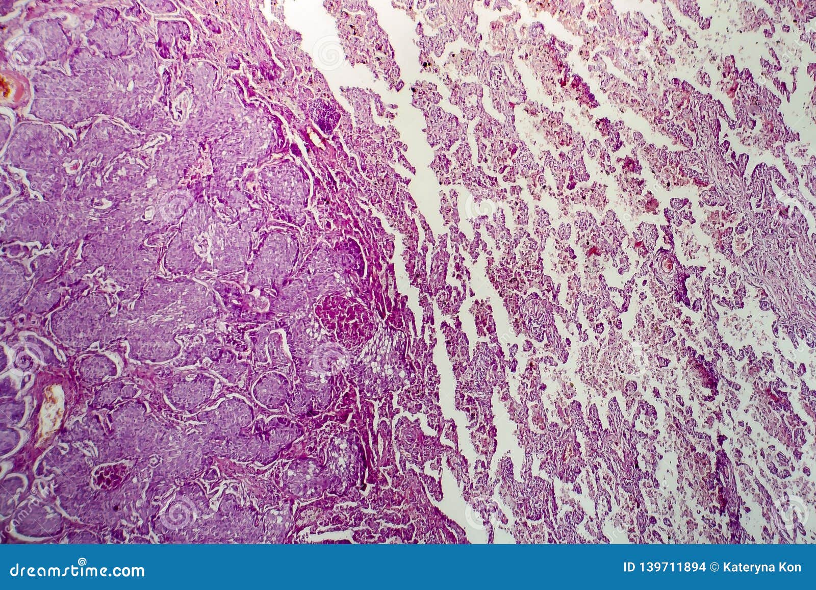 Lung Adenocarcinoma, Light Micrograph Royalty-Free Stock Photo ...