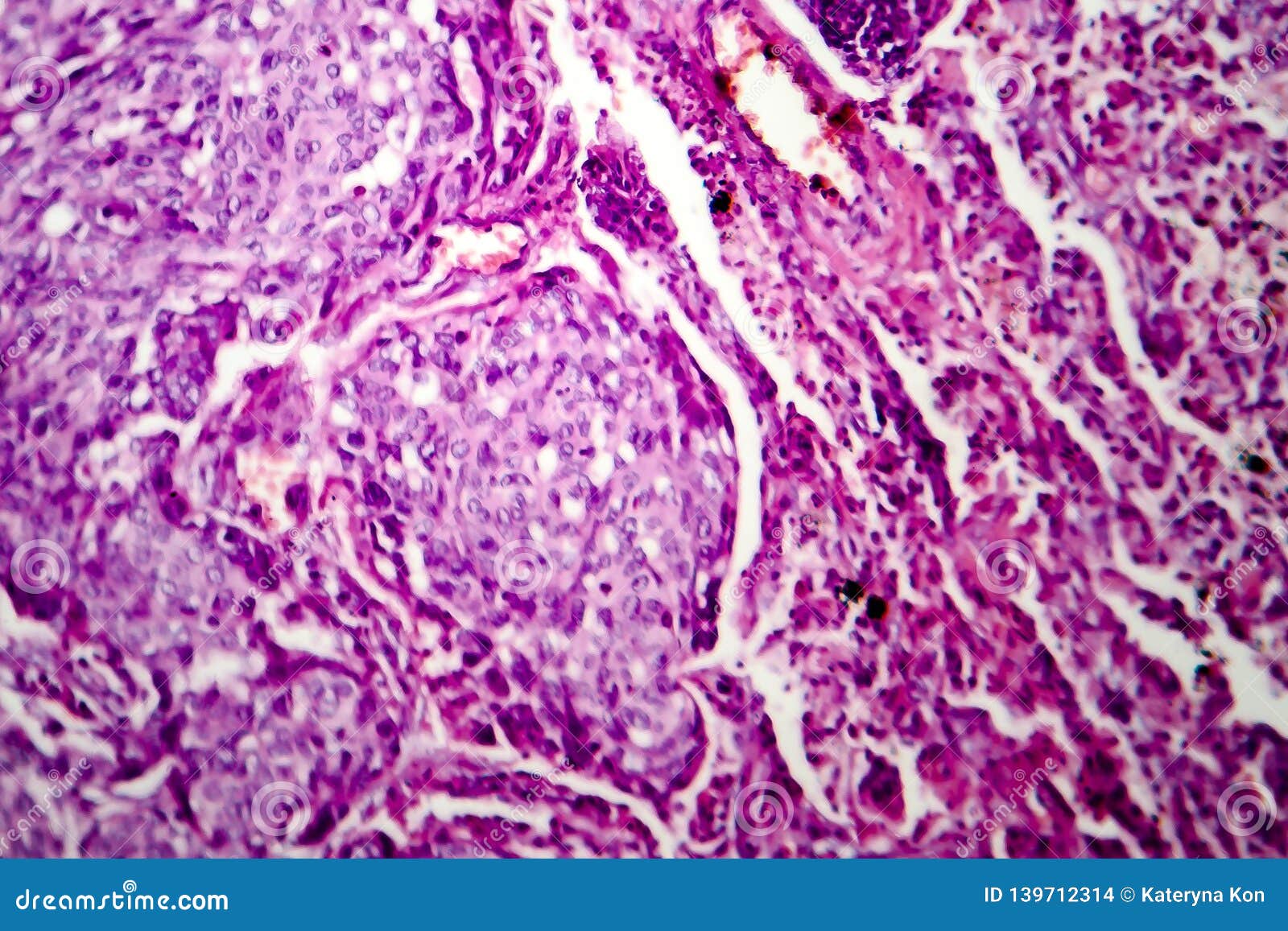 Lung Adenocarcinoma, Light Micrograph Stock Photo - Image of eosin ...