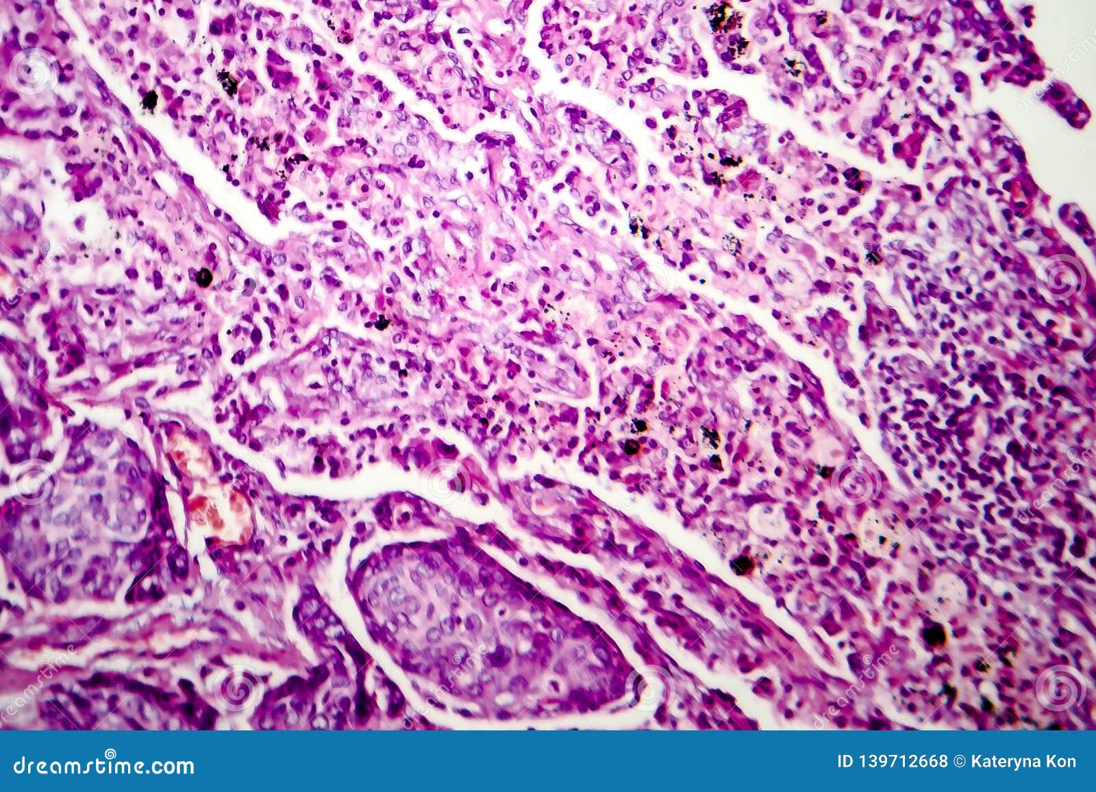 Lung Adenocarcinoma, Light Micrograph Stock Photo - Image of medicine ...
