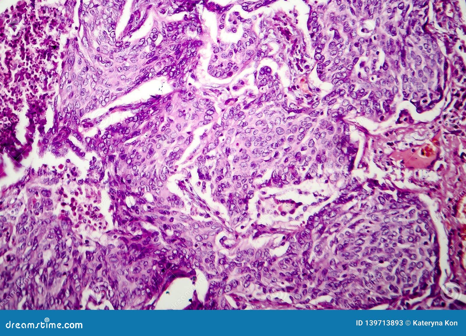 Lung Adenocarcinoma, Light Micrograph Stock Image - Image of ...