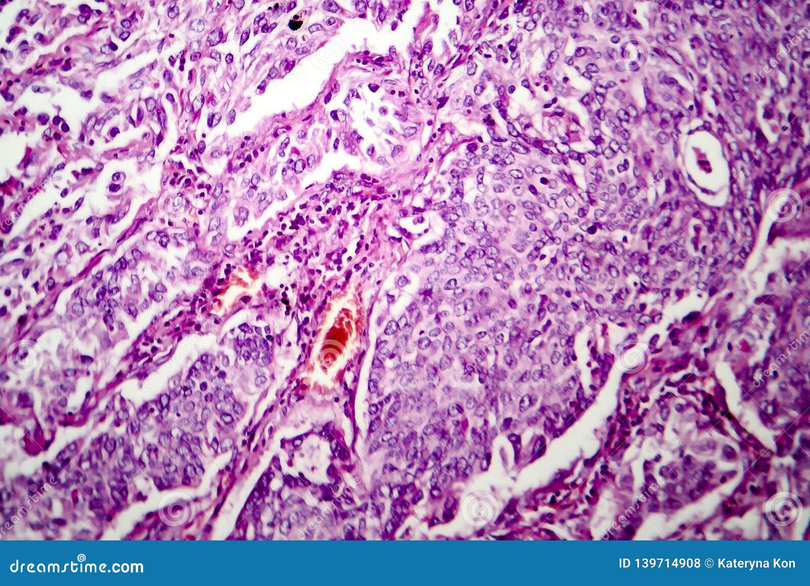 Lung Adenocarcinoma, Light Micrograph Stock Photo | CartoonDealer.com ...