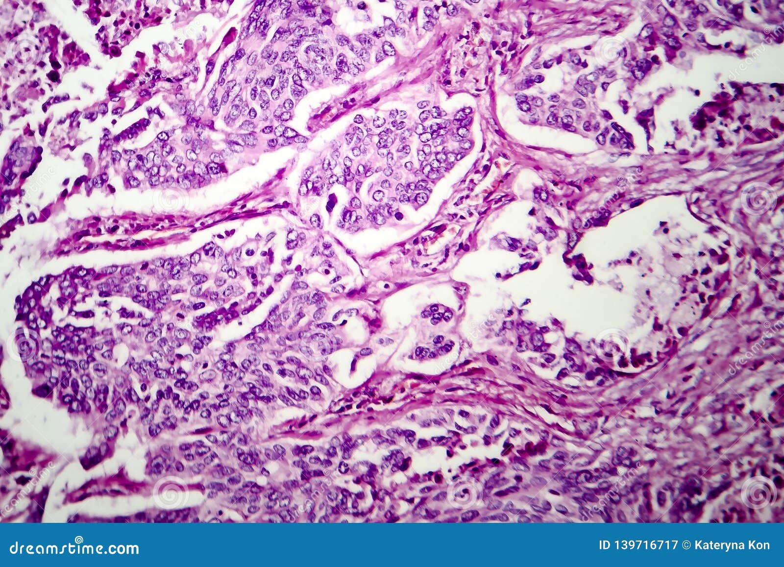 Lung Adenocarcinoma, Light Micrograph Royalty-Free Stock Photography ...