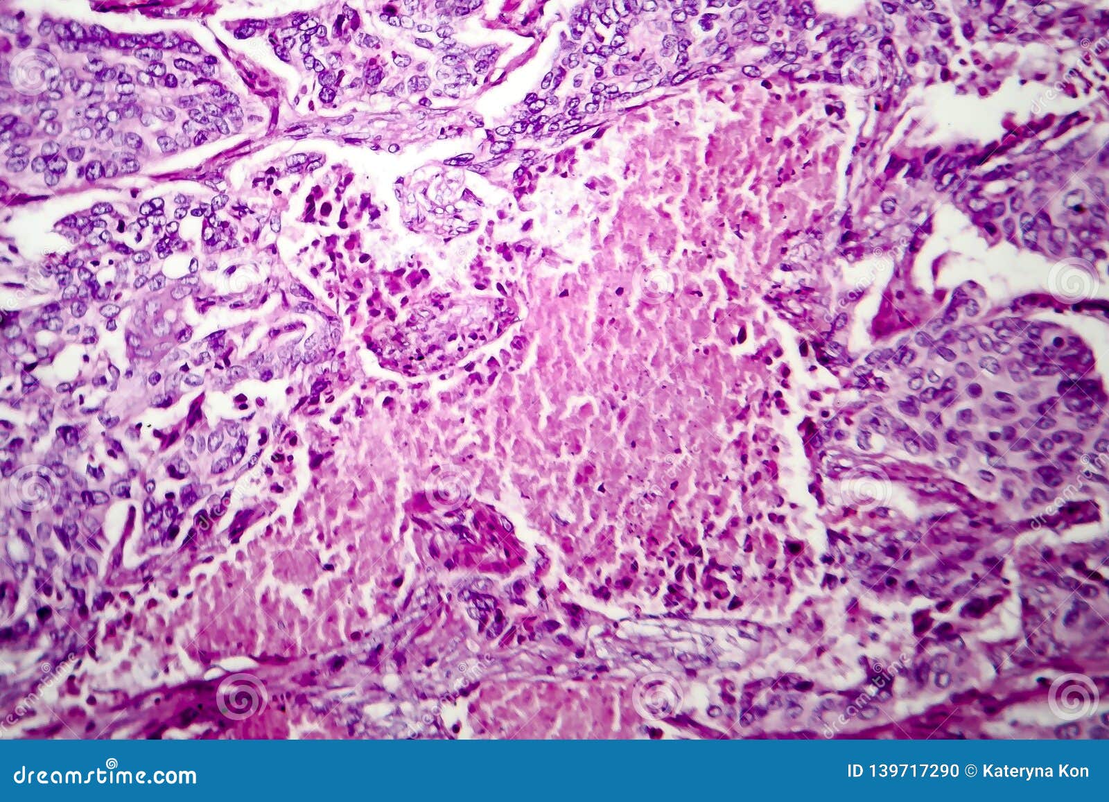 Lung Adenocarcinoma, Light Micrograph Stock Photo - Image of ...