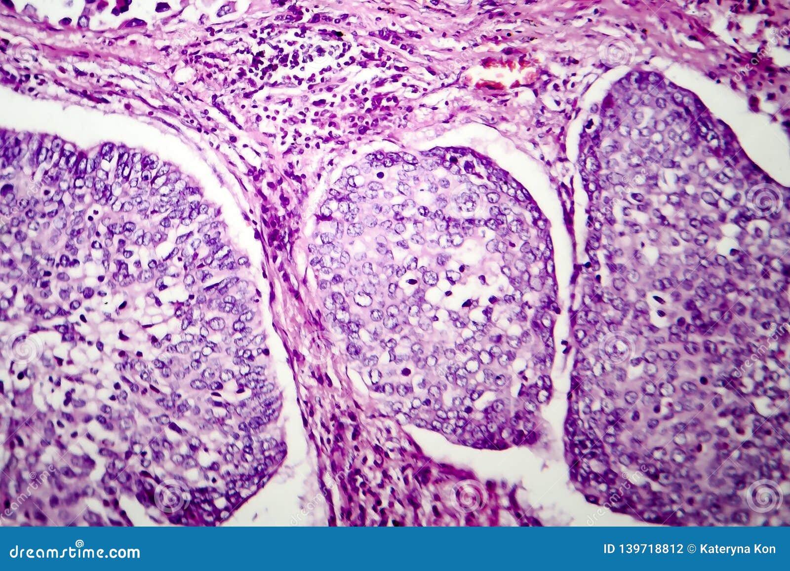 Lung Adenocarcinoma, Light Micrograph Stock Illustration - Illustration ...