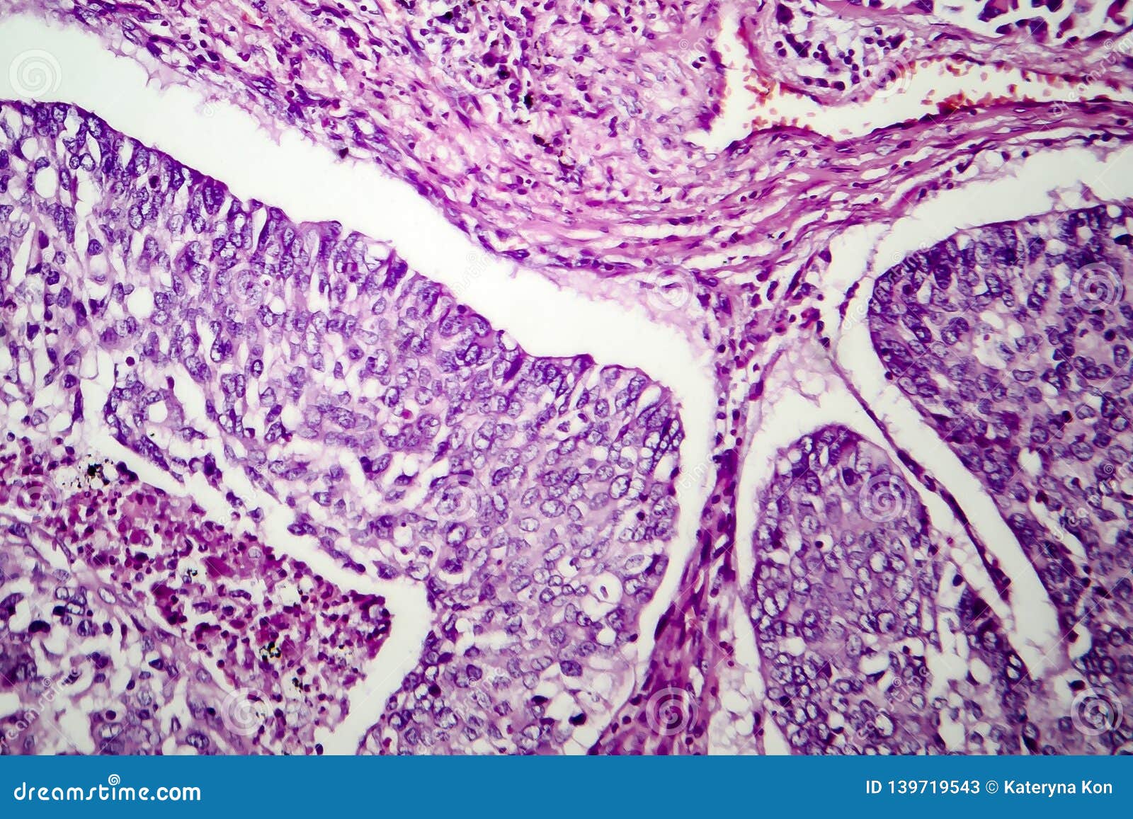 Lung Adenocarcinoma, Light Micrograph Stock Image - Image of eosin ...