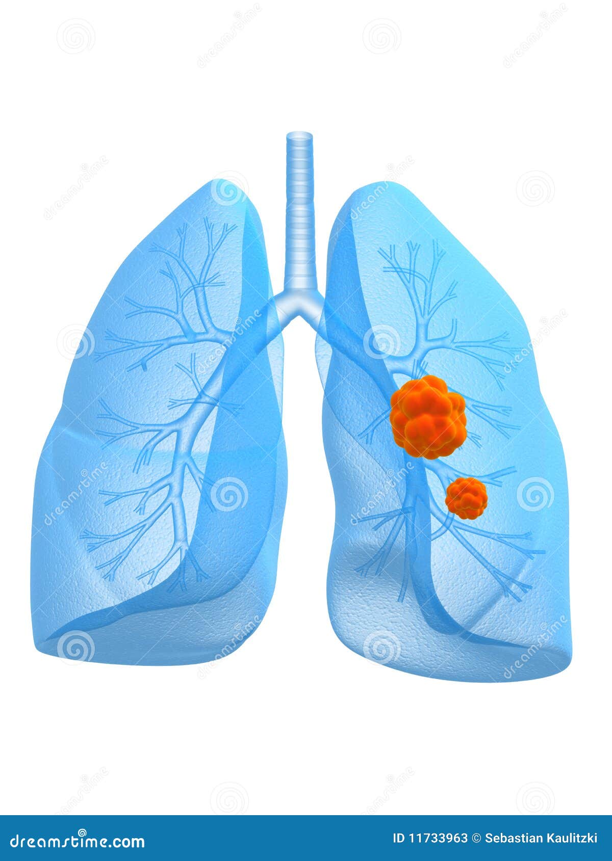 Lung cancer stock illustration. Illustration of cartoon - 11733963