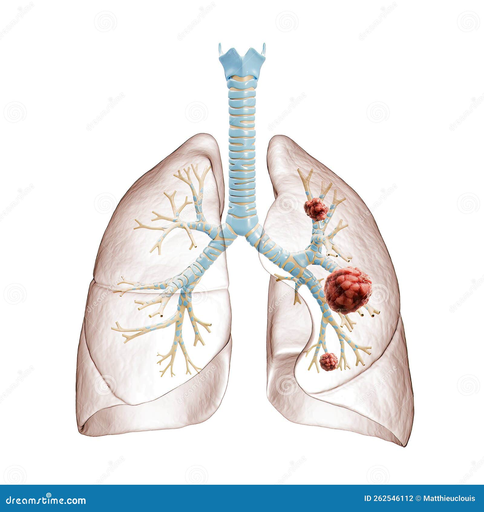 Lung Cancer Or Carcinoma 3d Rendering Illustration Bronchial Tree And Lungs Infected By Cancer