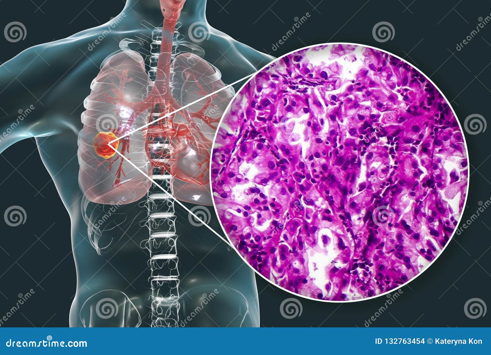 Lung Cancer, Illustration and Photo Under Microscope Stock Illustration ...