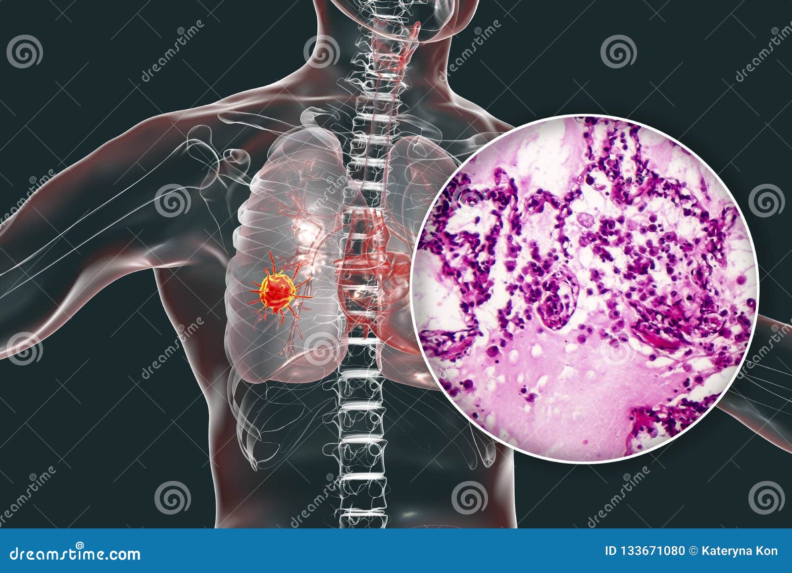 Lung Cancer, Illustration and Photo Under Microscope Stock Illustration ...