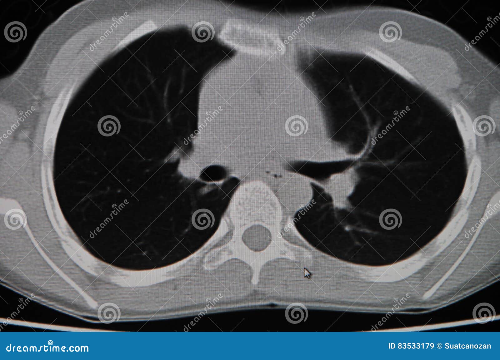 Lung CT stock image. Image of tomography, scan, imaging - 83533179