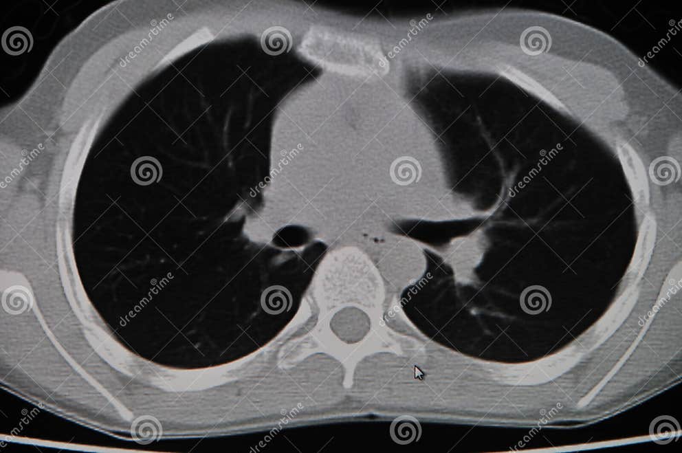 Lung CT stock image. Image of tomography, scan, imaging - 83533179