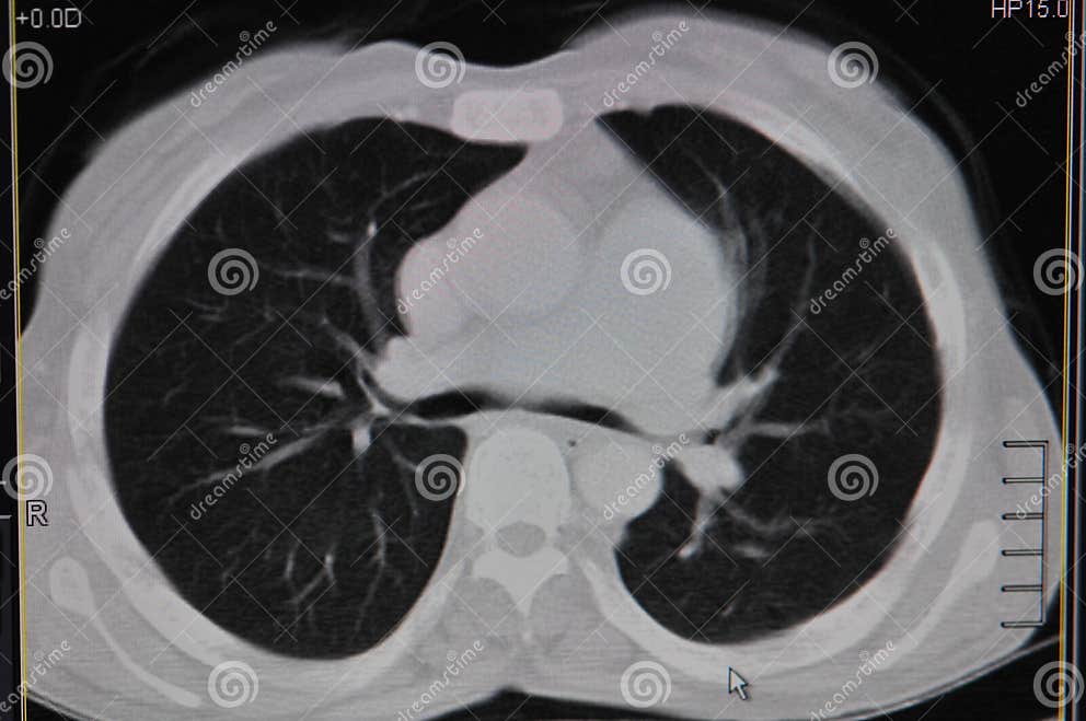 Lung CT stock image. Image of disease, radiology, hospital - 83533237