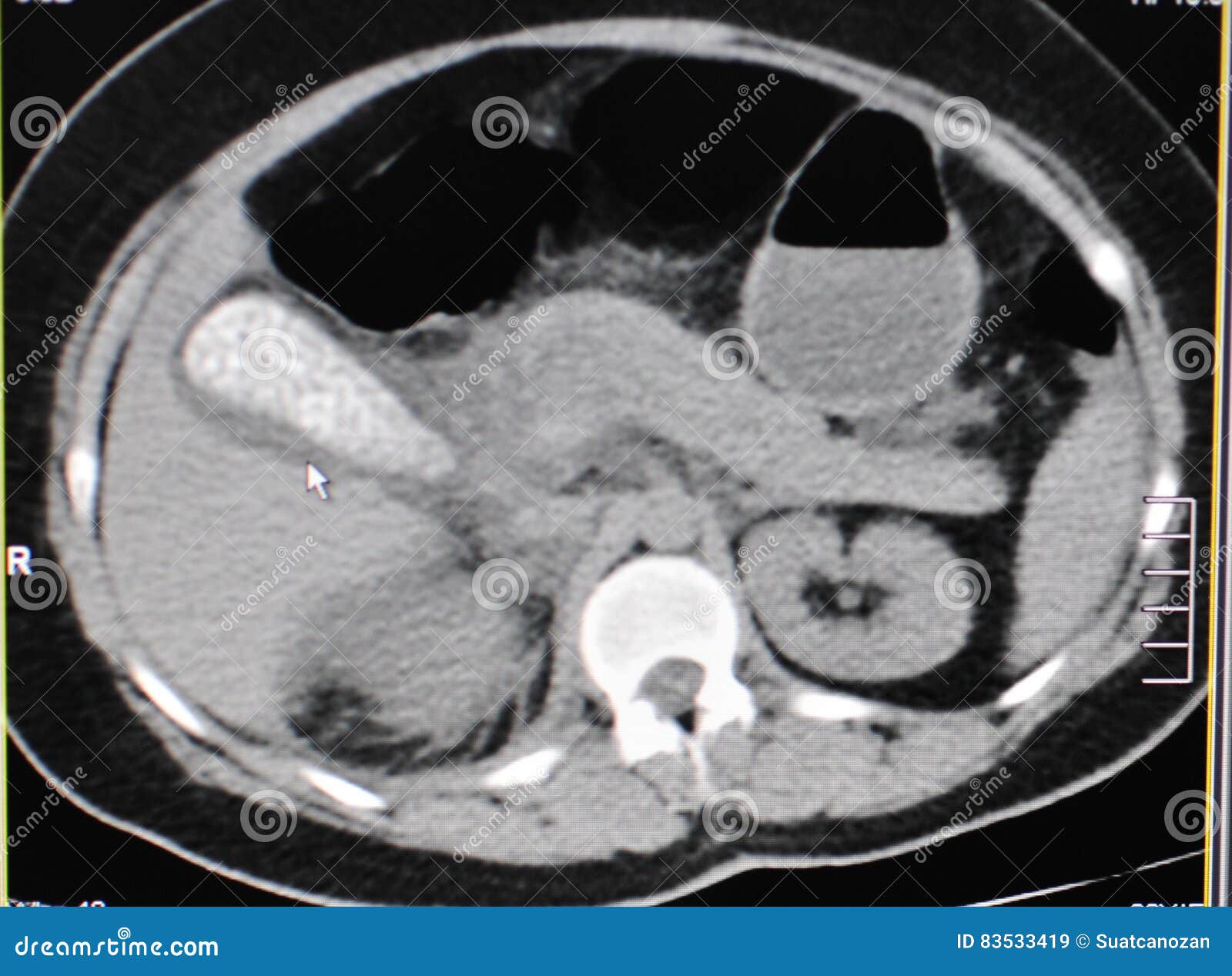 Normal Pancreas Cat Scan