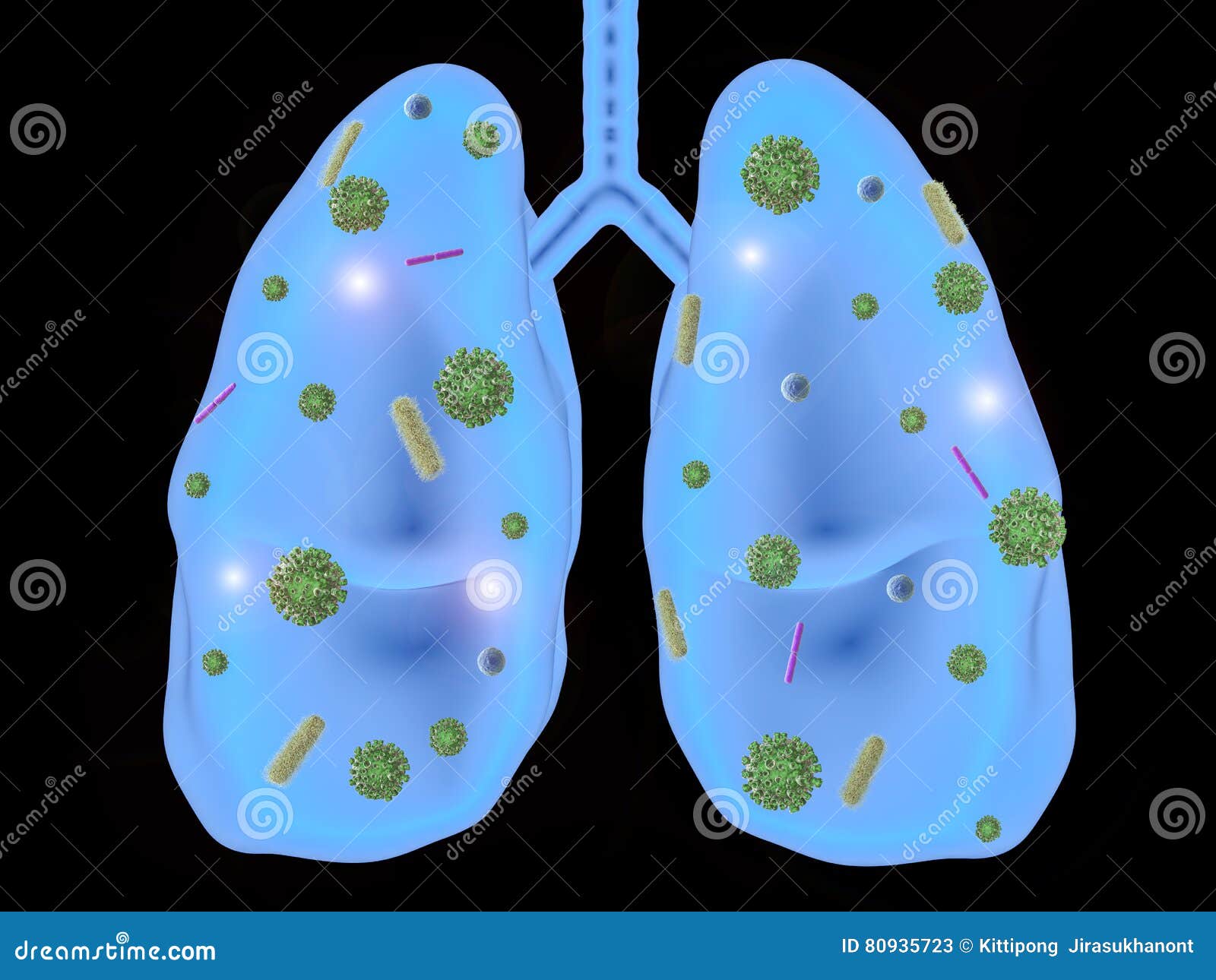 Lung Disease with Bacteria Cells Stock Image - Image of epidemic ...