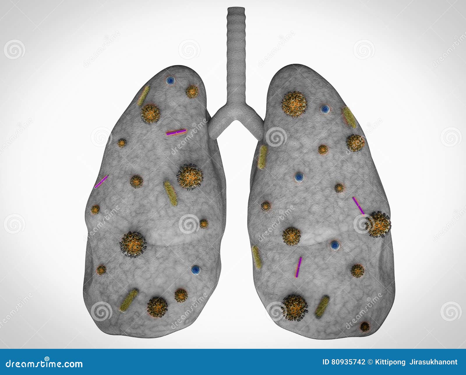 Lung Disease with Bacteria Cells Stock Photo - Image of lungs ...