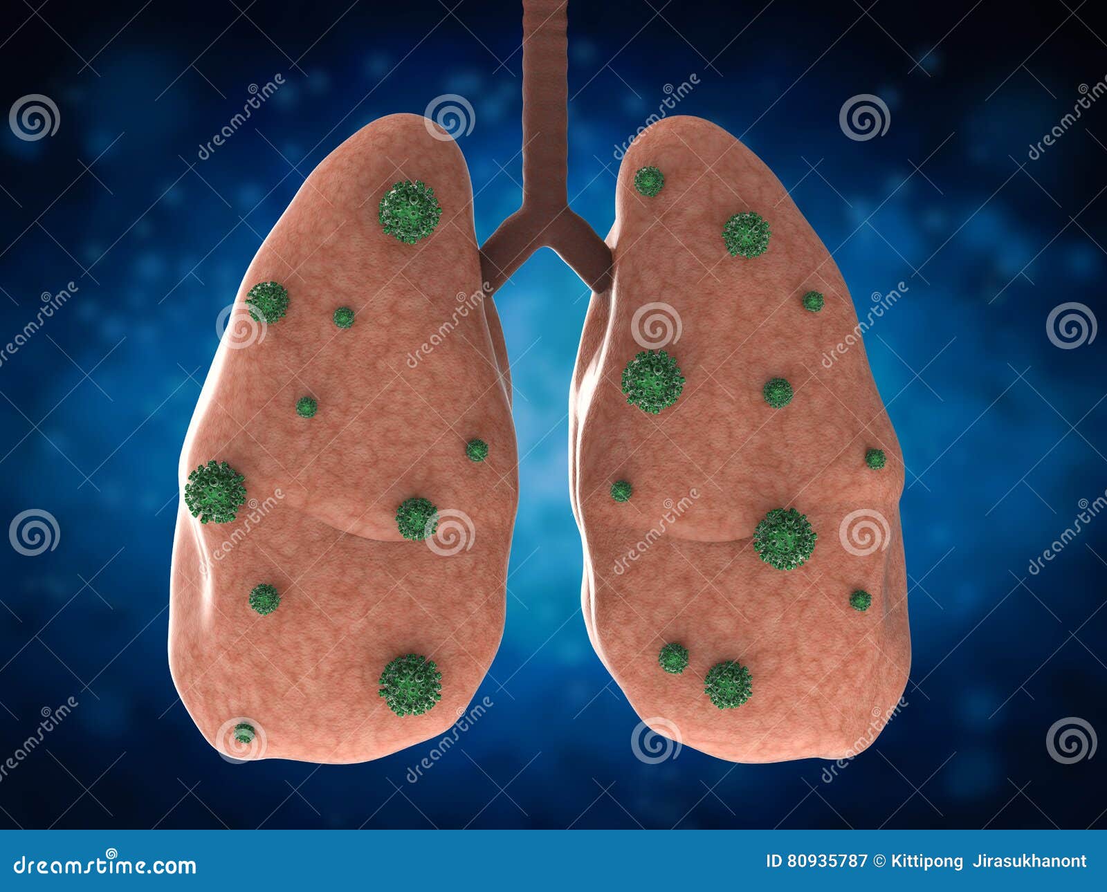 Lung Disease with Bacteria Cells Stock Image - Image of anatomy ...