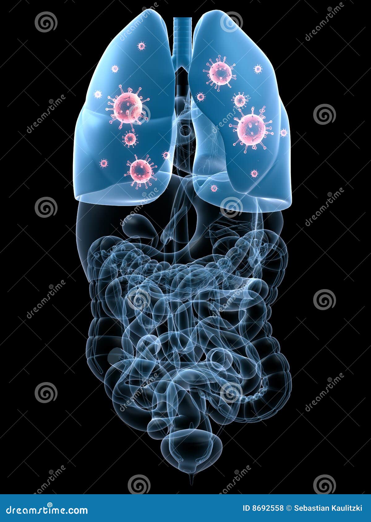 Lung Infection Caused By Bacteria Pseudomonas Aeruginosa Royalty-Free ...