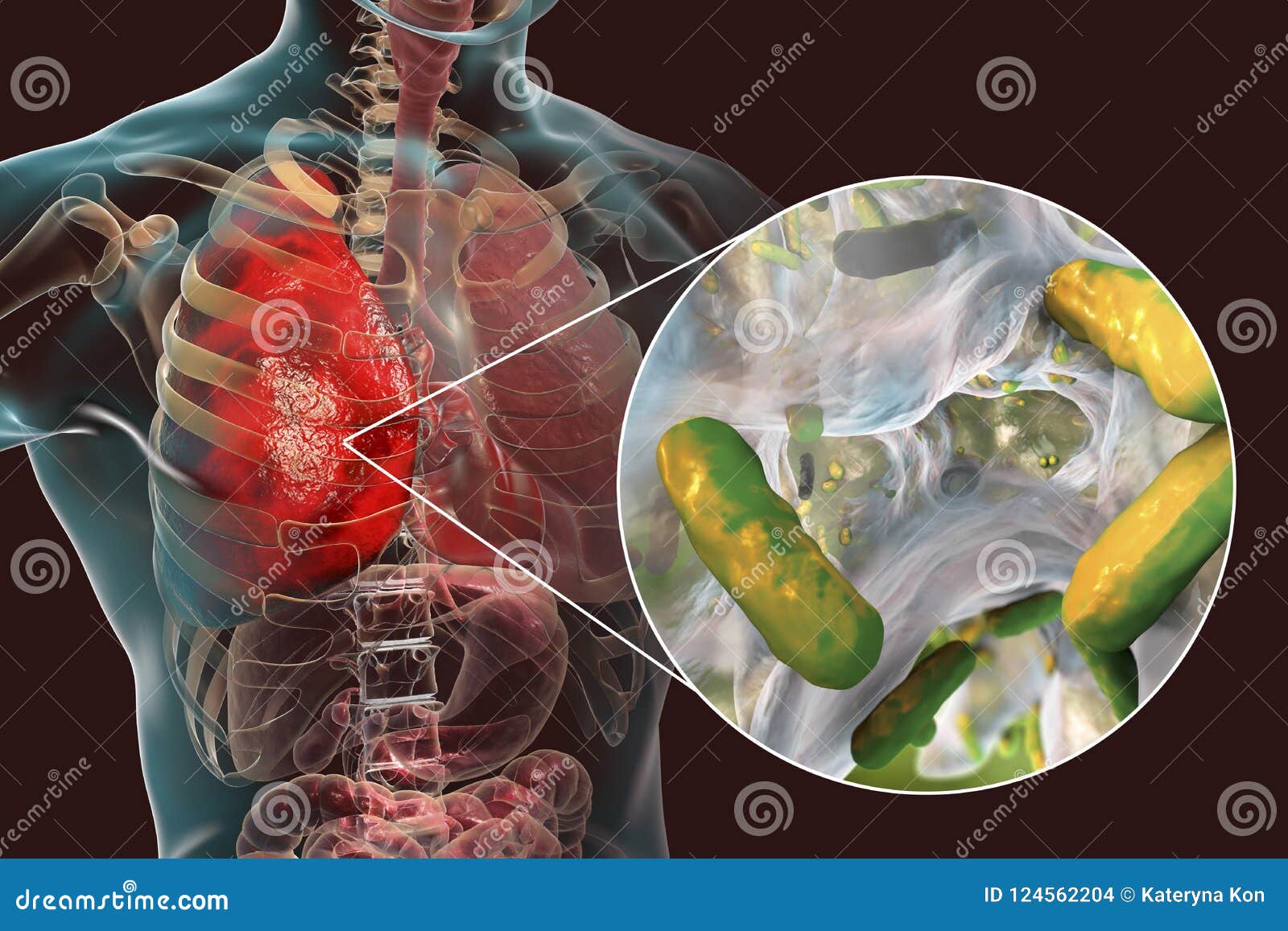 Lung Infection Caused by Bacteria Pseudomonas Aeruginosa Stock ... Lung Infection Caused by Bacteria Pseudomonas Aeruginosa Stock ...