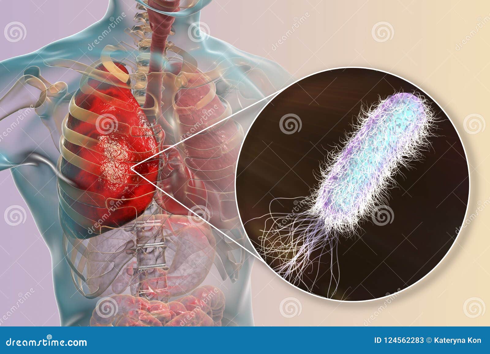Lung Infection Caused by Bacteria Pseudomonas Aeruginosa Stock ... Lung Infection Caused by Bacteria Pseudomonas Aeruginosa Stock ...