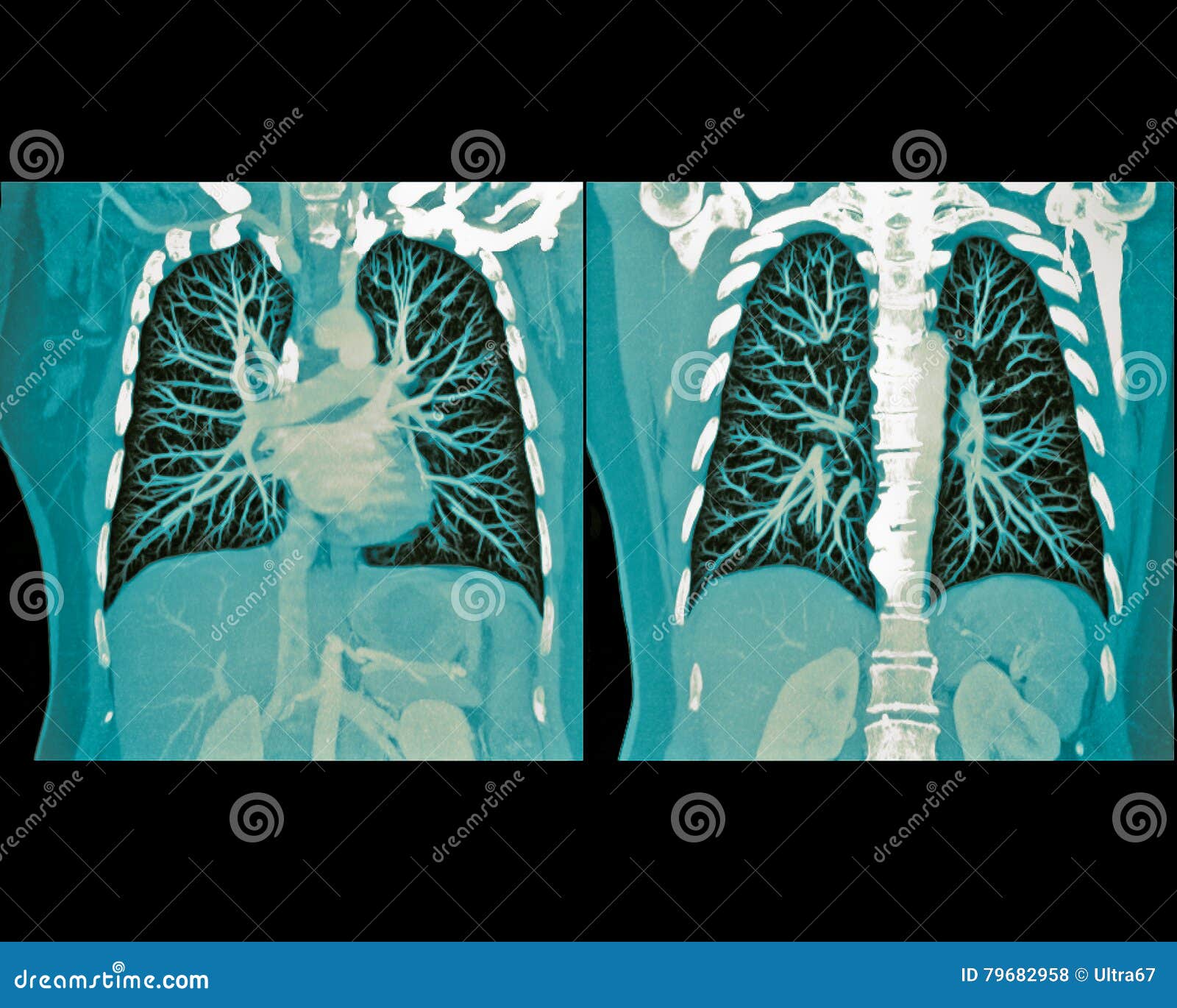 Lung scan stock illustration. Illustration of humerus - 79682958