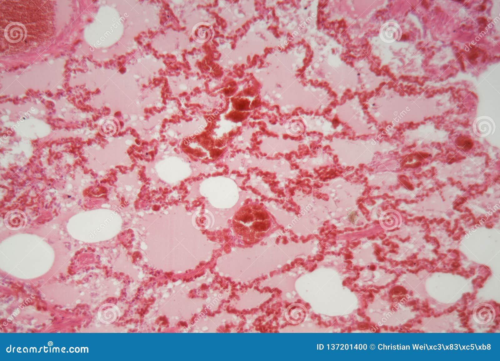 Lung Tissue with Pneumonia Infection Caused by Flu Viral Pneumonia ...