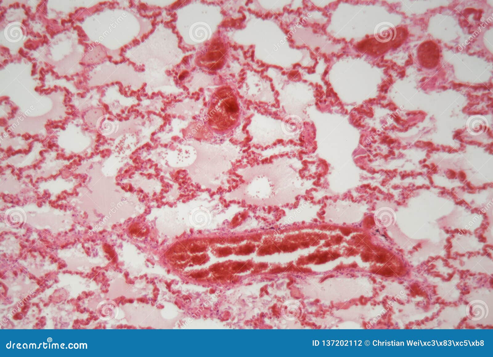 Lung Tissue with Pneumonia Infection Caused by Flu Viral Pneumonia ...