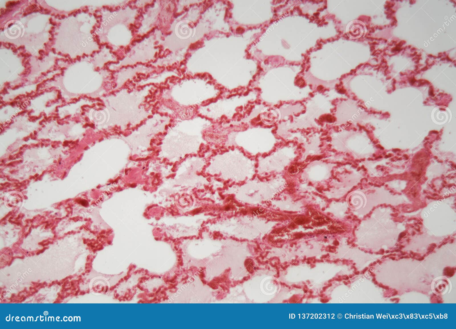 Lung Tissue with Pneumonia Infection Caused by Flu Viral Pneumonia ...