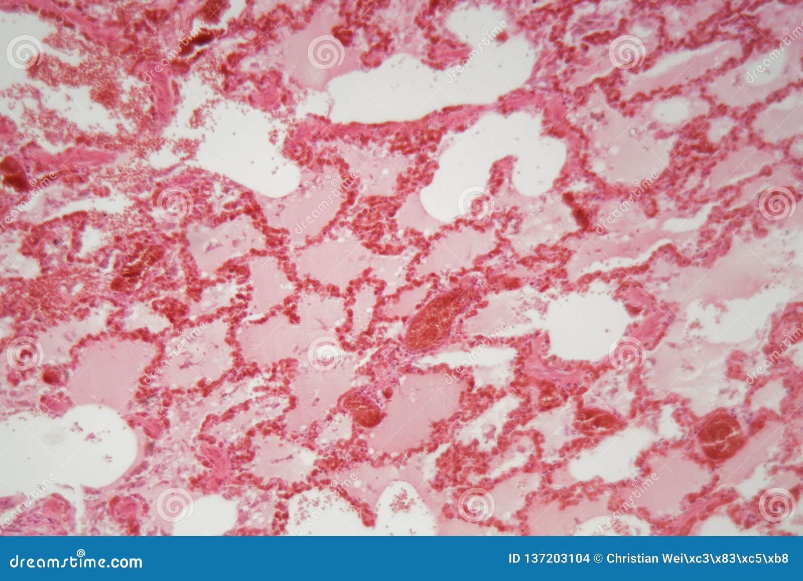 Lung Tissue with Pneumonia Infection Caused by Flu Viral Pneumonia ...
