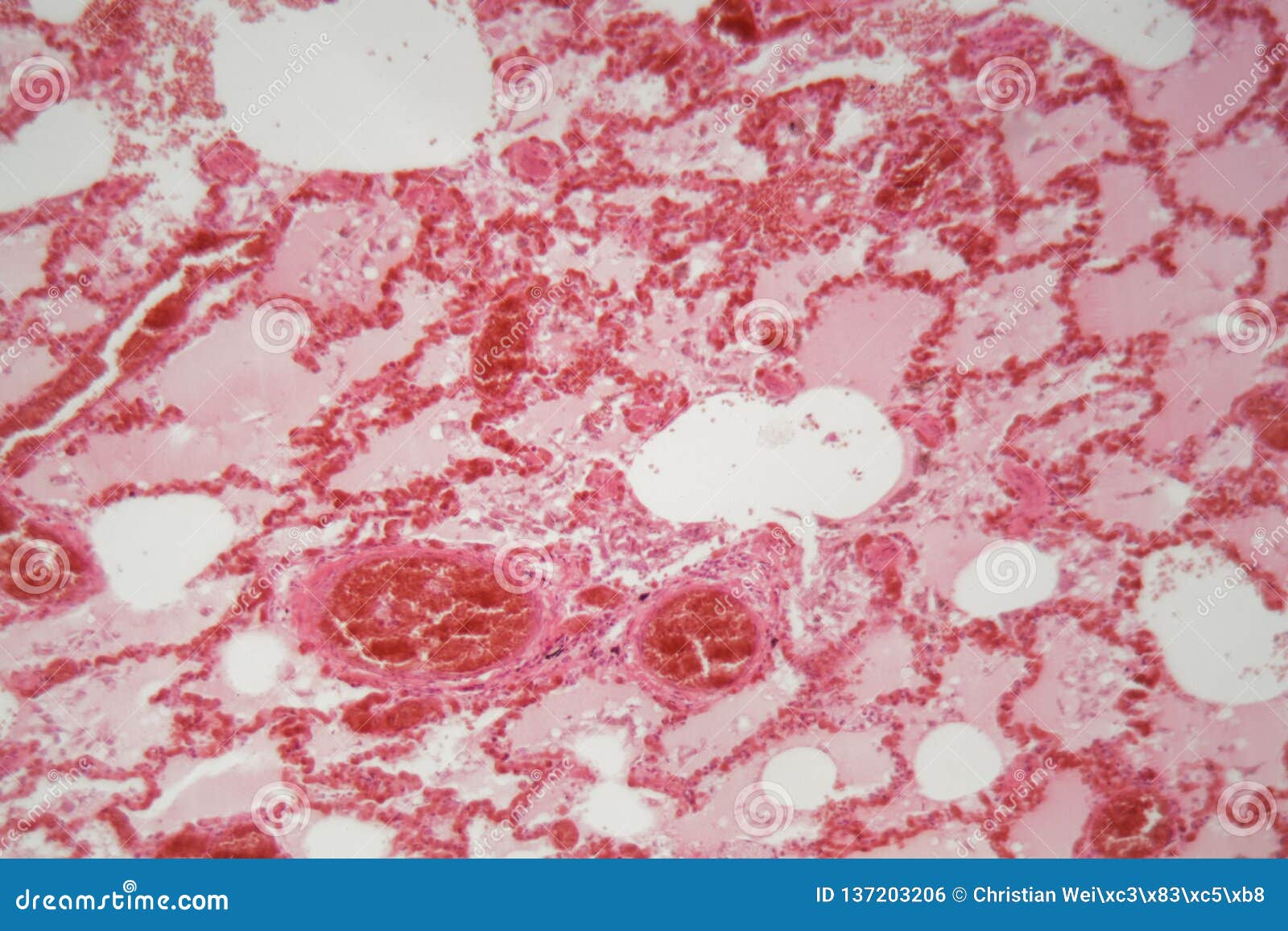 Viral Pneumonia Cell