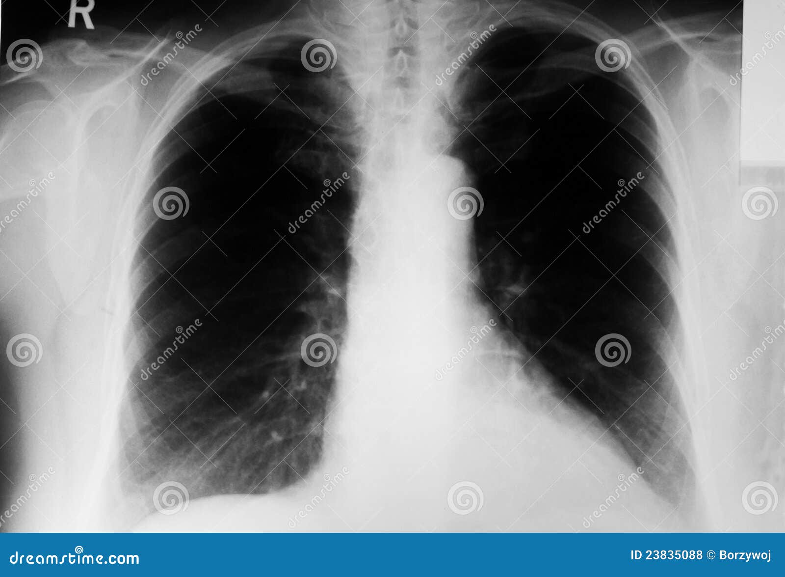 Lung xray stock photo. Image of scan, body, human, radiography - 23835088