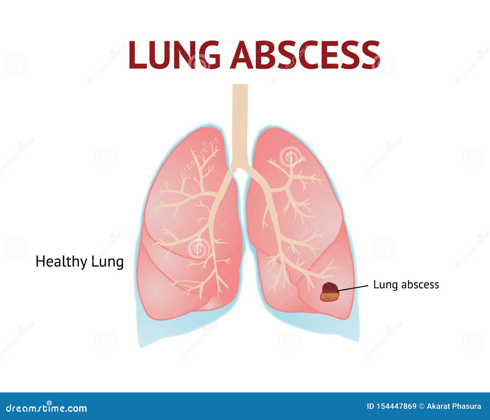 Lungs Abscess Lungs Disease Isolated Vector Illustration On White