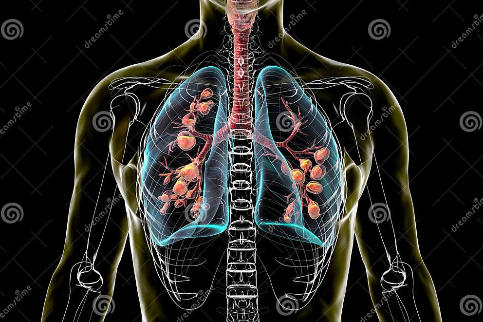 Lungs Affected By Cystic Fibrosis 3d Illustration Stock Illustration