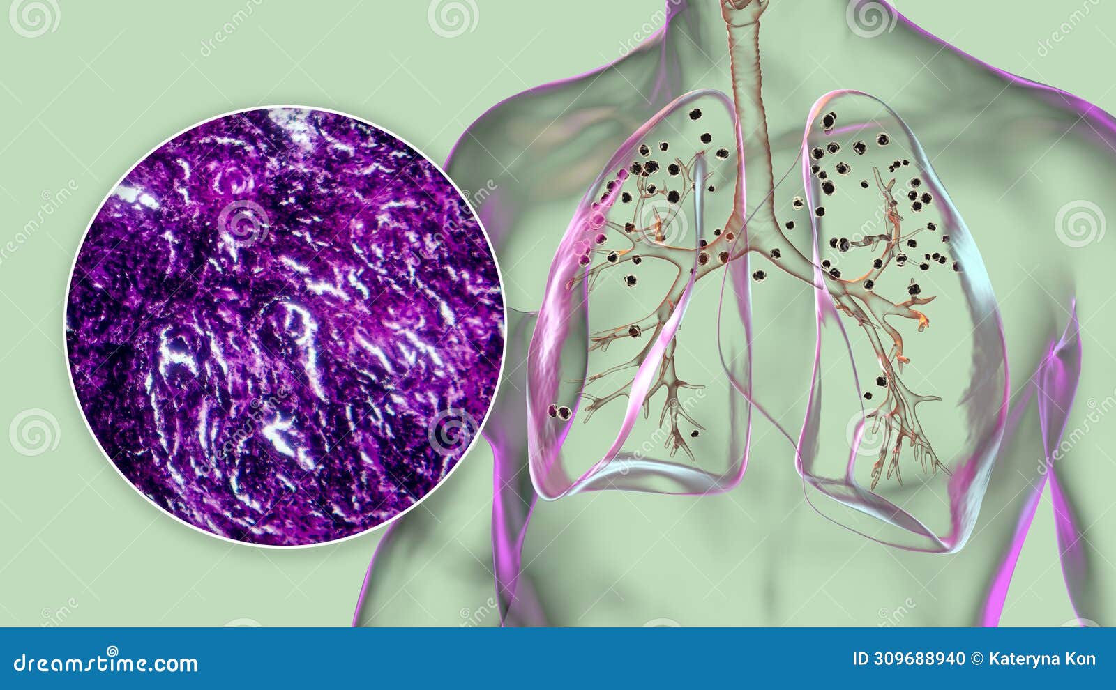 Lungs Affected by Silicosis, 3D Illustration and Micrograph Stock ...