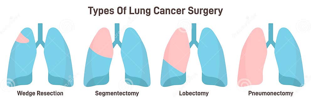 Lungs Cancer Surgery Types Wedge Resection Segmentectomy Stock Vector