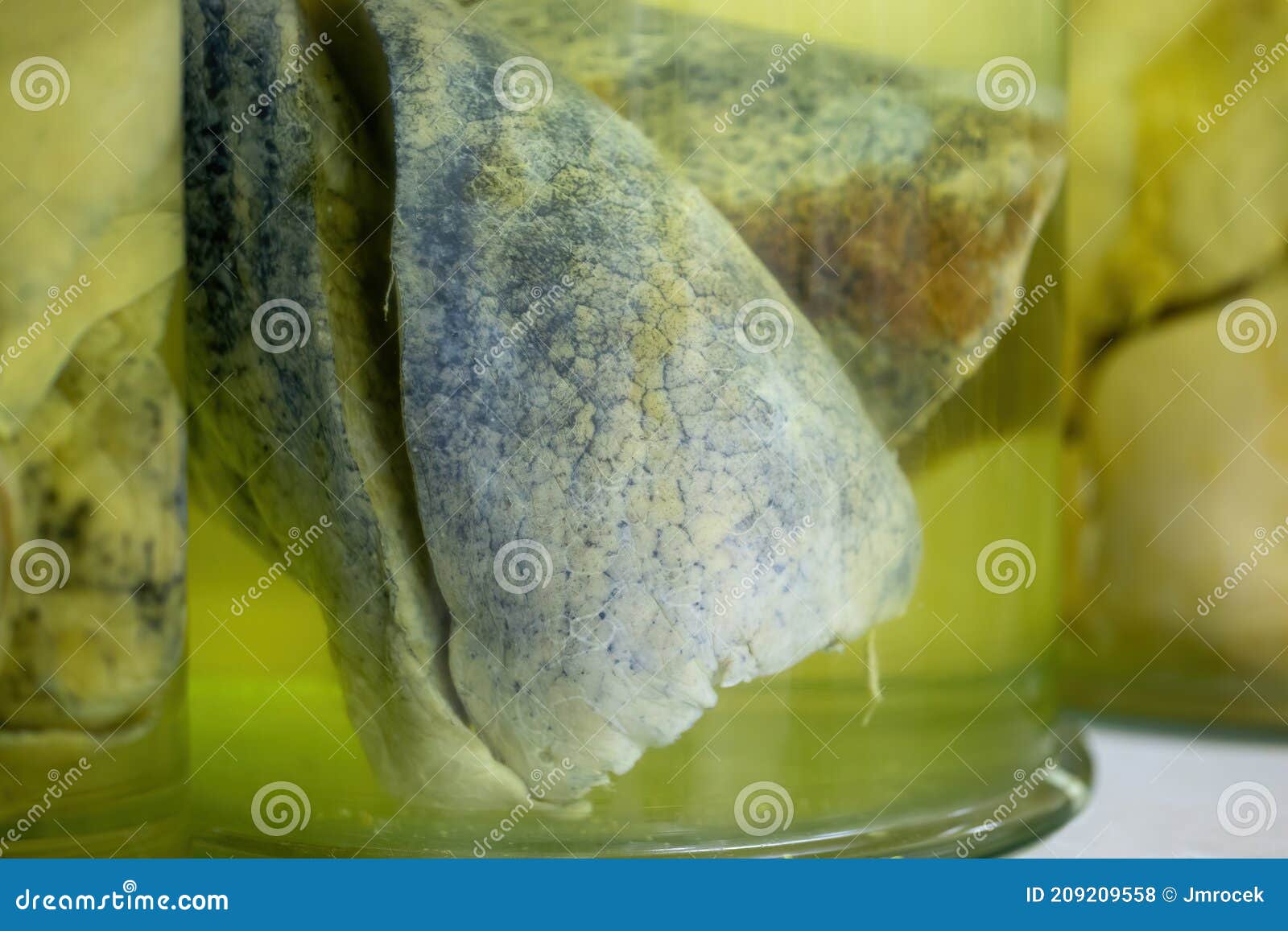 Lungs with Cancerous Changes Floating Inside Jar with Formaldehyde in ...
