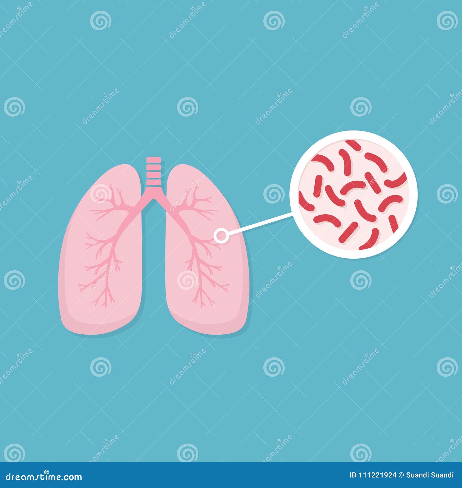 Lungs Of Infected Person Mycobacterium Tuberculosis Close Up