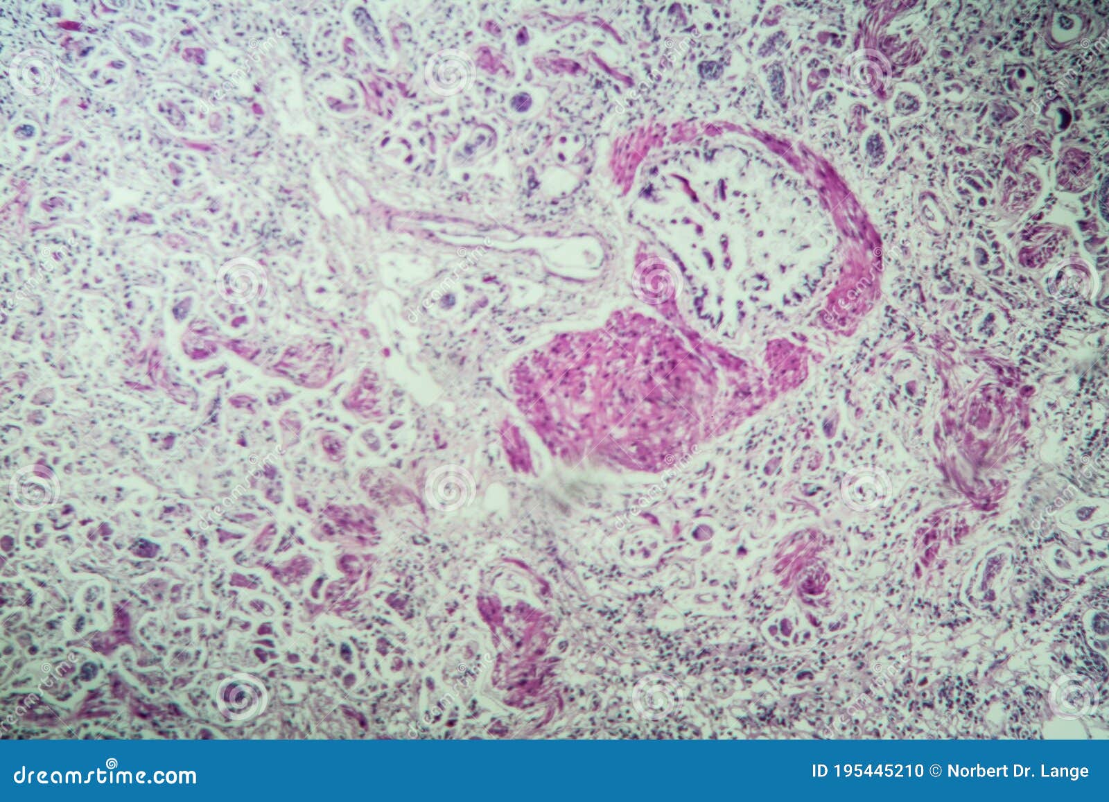 Lungworm Under the Microscope Stock Photo - Image of pathology, worms ...