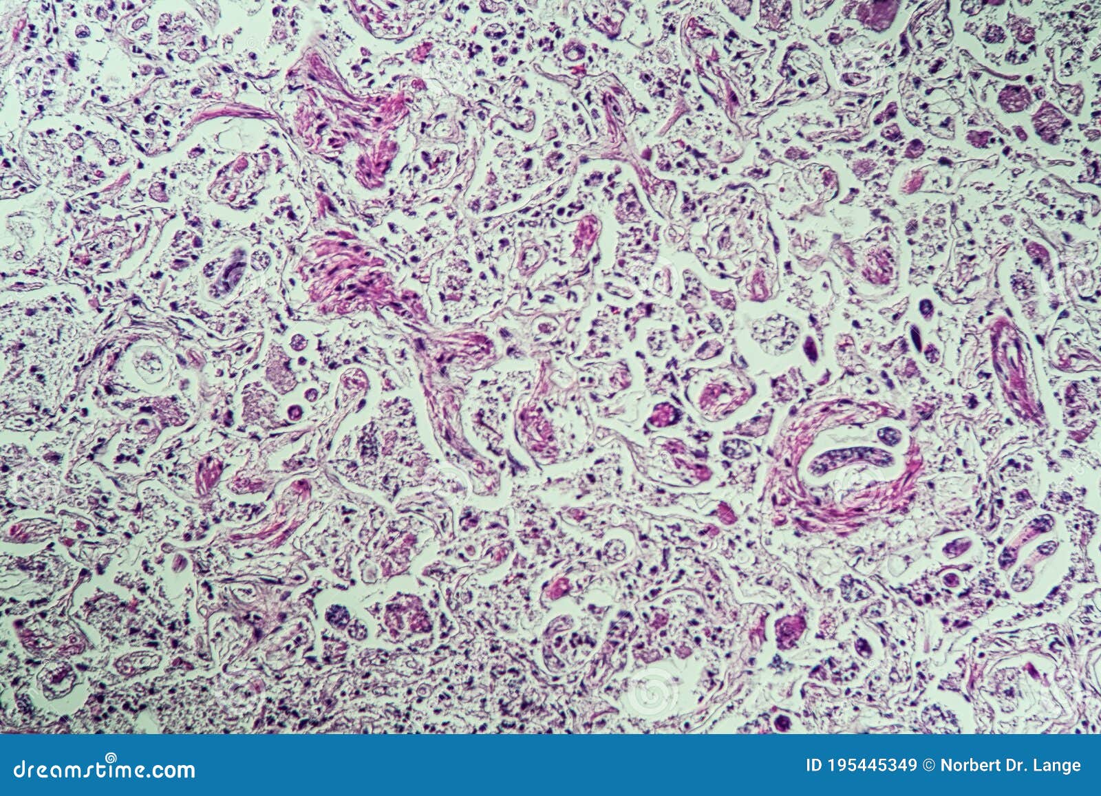 Lungworm Under the Microscope Stock Image - Image of diseases ...